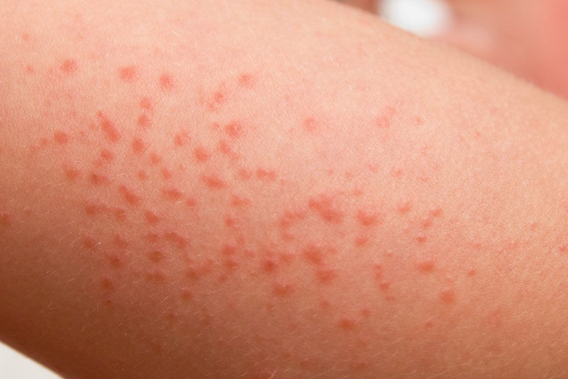 Röteln: Typische Symptome, Ursachen und Behandlung