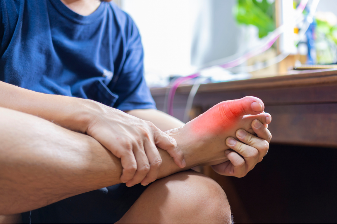 Gicht – Ursachen, Symptome und Behandlungsmöglichkeiten